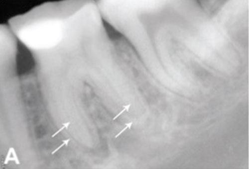 Root Canal Point | Preserve Roots, Cherish Teeth | Endodontic Clinic ...
