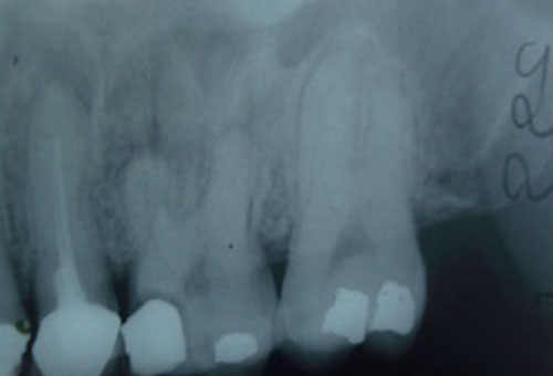 Root Canal Point | Preserve Roots, Cherish Teeth | Endodontic Clinic ...