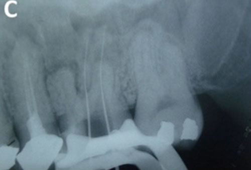 Root Canal Point | Preserve Roots, Cherish Teeth | Endodontic Clinic ...