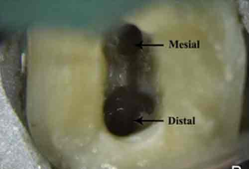 Root Canal Point | Preserve Roots, Cherish Teeth | Endodontic Clinic ...