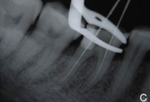 Root Canal Point | Preserve Roots, Cherish Teeth | Endodontic Clinic ...