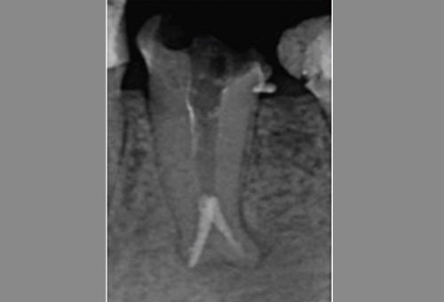 Root Canal Point | Preserve Roots, Cherish Teeth | Endodontic Clinic ...