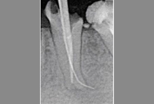 Root Canal Point | Preserve Roots, Cherish Teeth | Endodontic Clinic ...