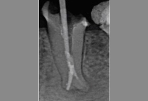 Root Canal Point | Preserve Roots, Cherish Teeth | Endodontic Clinic ...