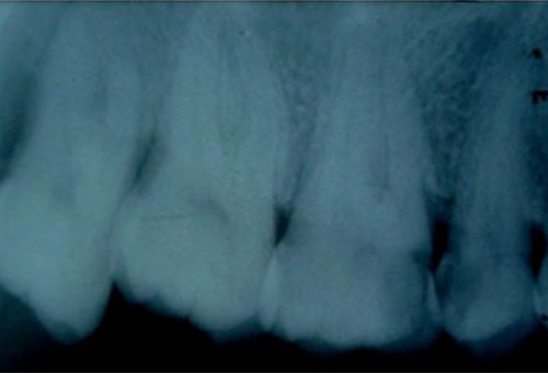 Root Canal Point | Preserve Roots, Cherish Teeth | Endodontic Clinic ...