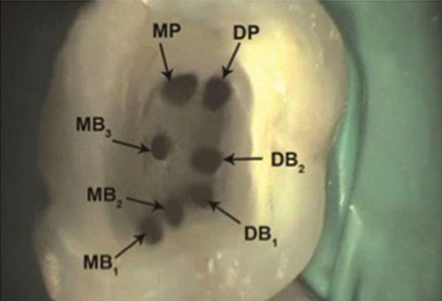 Root Canal Point | Preserve Roots, Cherish Teeth | Endodontic Clinic ...