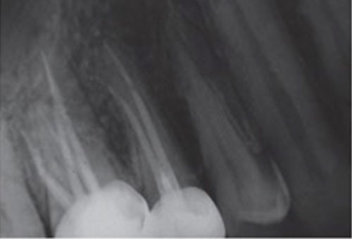 Root Canal Point | Preserve Roots, Cherish Teeth | Endodontic Clinic ...