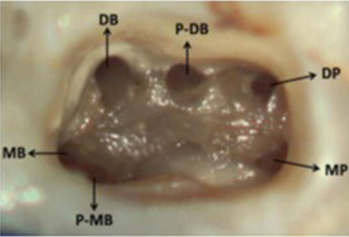 Root Canal Point | Preserve Roots, Cherish Teeth | Endodontic Clinic ...
