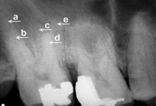 Root Canal Point | Preserve Roots, Cherish Teeth | Endodontic Clinic ...