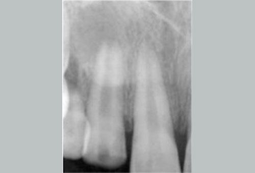 Root Canal Point | Preserve Roots, Cherish Teeth | Endodontic Clinic ...