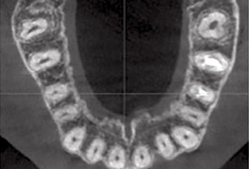 Root Canal Point | Preserve Roots, Cherish Teeth | Endodontic Clinic ...