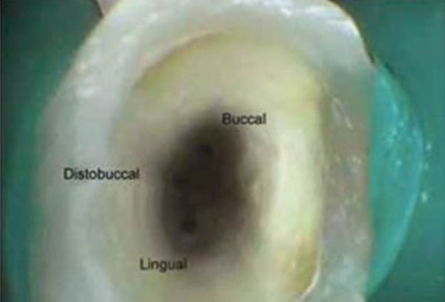 Root Canal Point | Preserve Roots, Cherish Teeth | Endodontic Clinic ...