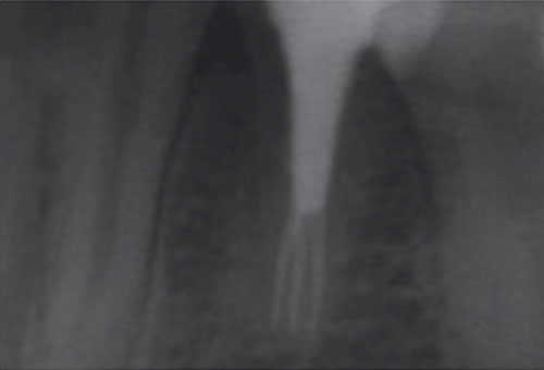 Root Canal Point | Preserve Roots, Cherish Teeth | Endodontic Clinic ...